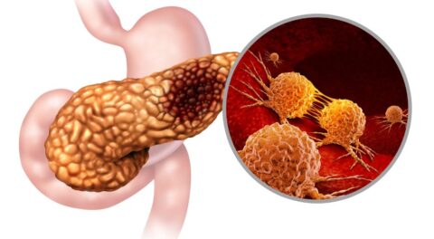 Pancreatic Cancer Causes & Risk Factors - Surgical Associates of ...