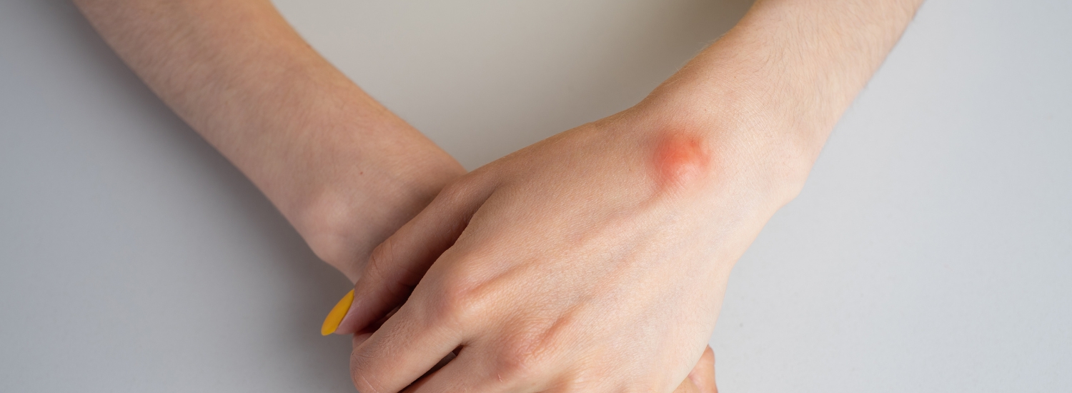 Skin Lesions, Masses, and Cysts | When to See a Doctor